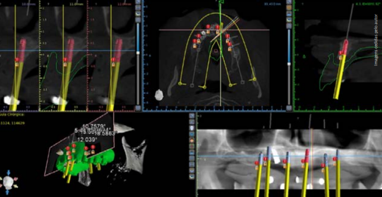 Aplicação prática do fluxo digital para próteses totais - Conexão ...