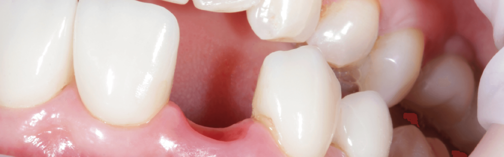 Como lidar com casos de alveolite - Conexão Odontoprev